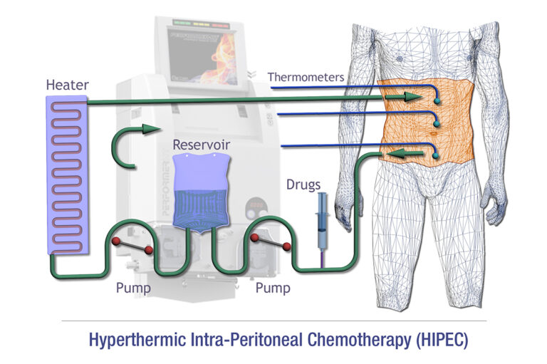 PIPAC и HIPEC - конкурентни или допълващи терапевтични методи